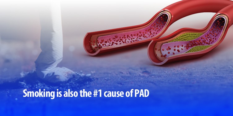 10 FACTS:Peripheral Arterial Disease | Maryland Vascular Specialists